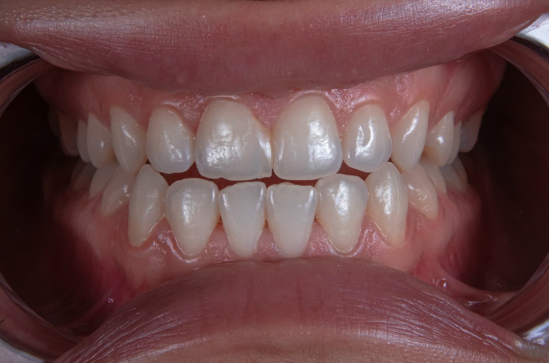 9 Warning Signs Of Gum Disease You Shouldn't Ignore